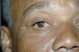 Double Vision and Cataracts - Golden Eye Optometry